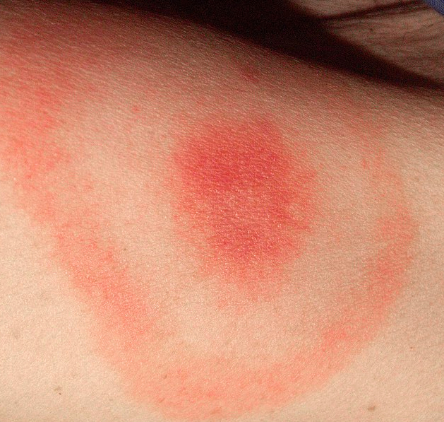 Interlude: a tale of two infections | Ruth's Coastal Walk (UK)